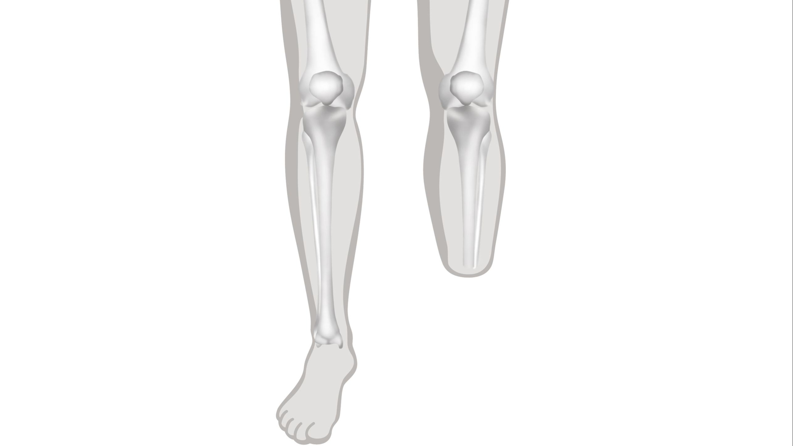 Amputation Membres Inférieurs